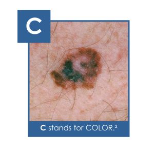 The ABCDEs of Melanoma — Houston Dermatology Specialists
